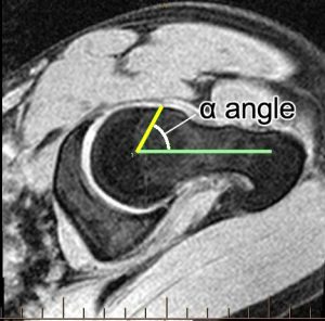 What does the alpha angle suggest in this hip?
