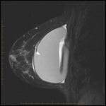 A look at intracapsular implant rupture