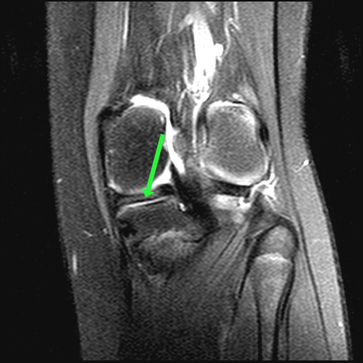 Horizontal Meniscal Tear - ProScan Education