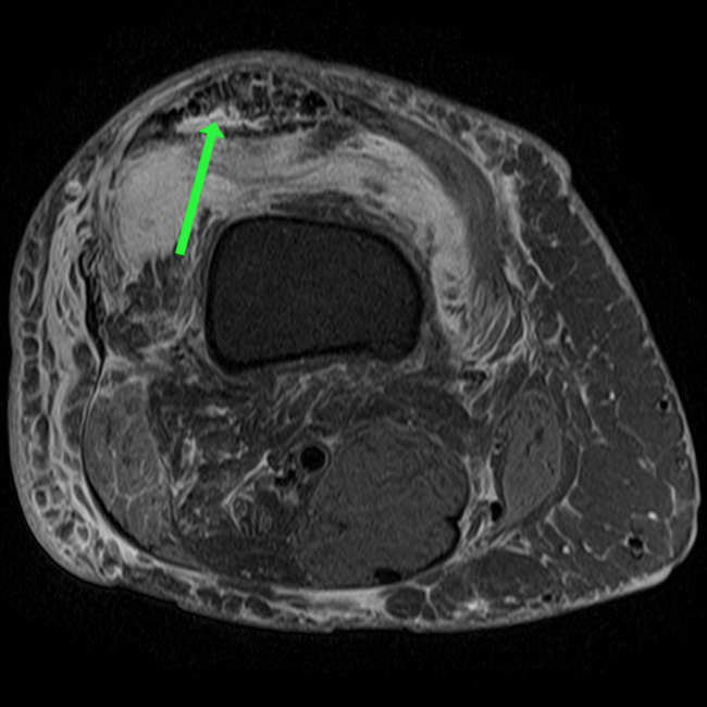 Patellar Ligament [Quadriceps Tendon] - ProScan Education