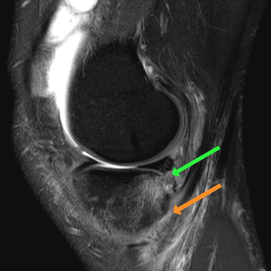 Posteromedial Corner - ProScan Education