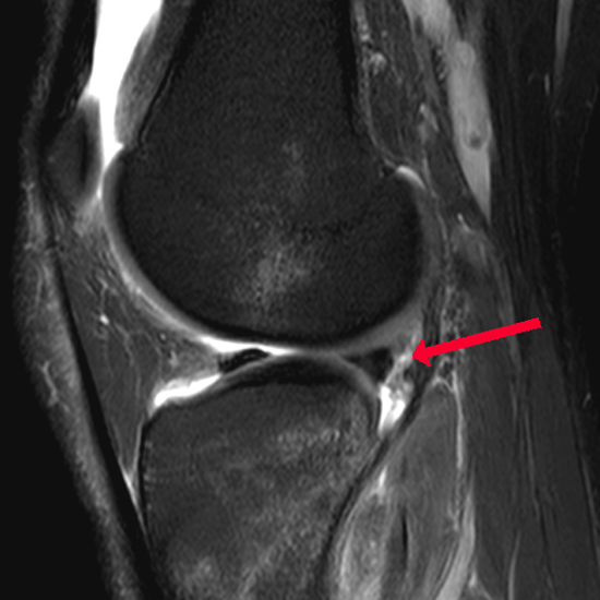 Posteromedial Corner - ProScan Education