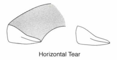 Horizontal Meniscal Tear - ProScan Education