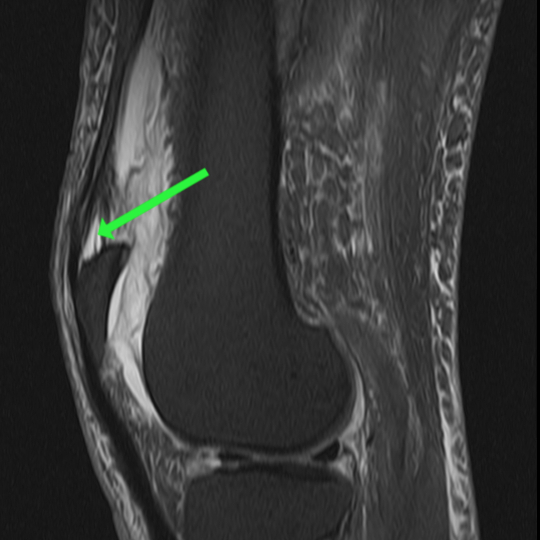 Patellar Ligament [Quadriceps Tendon] - ProScan Education