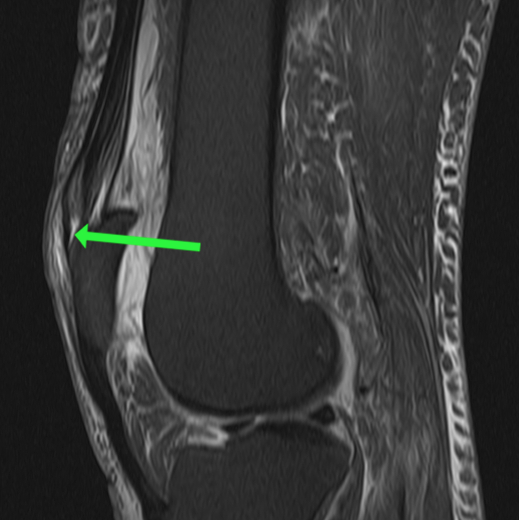 Patellar Ligament [Quadriceps Tendon] - ProScan Education