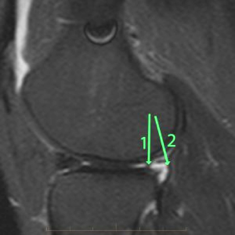 Meniscocapsular Separation - ProScan Education