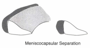 Meniscocapsular Separation - ProScan Education