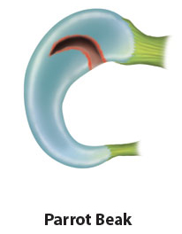 Parrot Beak Tear - ProScan Education