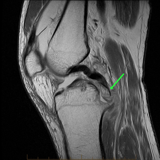 Posterior Cruciate Ligament - ProScan Education