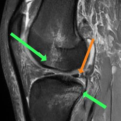 Vertical Tear - ProScan Education
