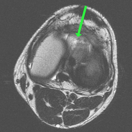 Cyclops Lesion - ProScan Education