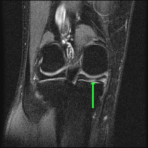 Horizontal Meniscal Tear - ProScan Education