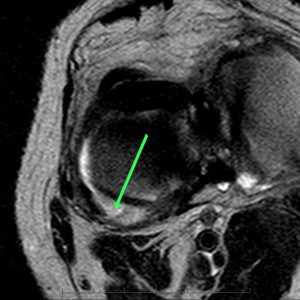 Meniscocapsular Separation - ProScan Education