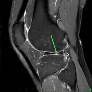 Parrot Beak Tear - ProScan Education