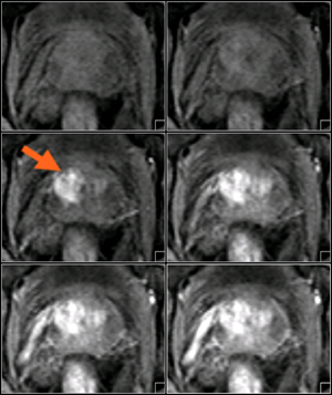 Prostate MRI Reference Guide - PI-RADS version 2