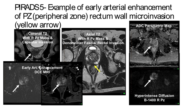 Prostate MRI Reference Guide - PI-RADS version 2