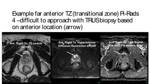 Prostate MRI Reference Guide - PI-RADS version 2