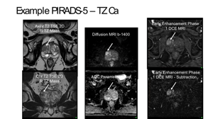 Prostate MRI Reference Guide - PI-RADS version 2