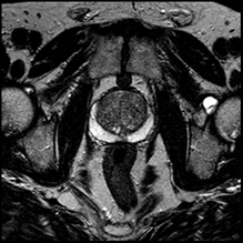 Prostate MRI Reference Guide - PI-RADS version 2