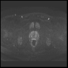 Prostate MRI Reference Guide - PI-RADS version 2
